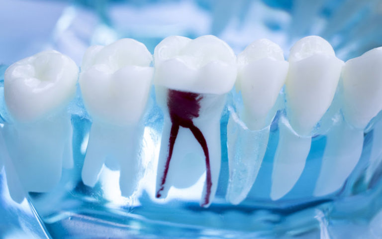 Root Canal Therapy - Glazer Dental Associates - Durham, CT